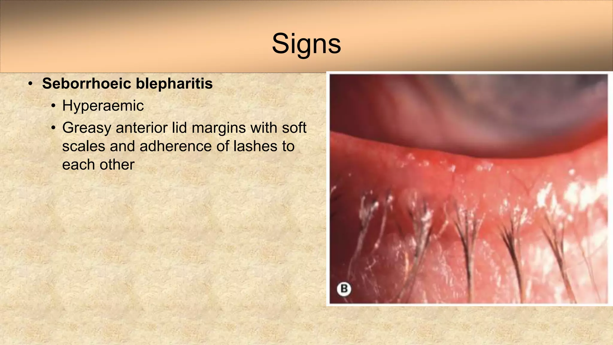 Bacterial eyelid infections and blepharitis. | PPTX