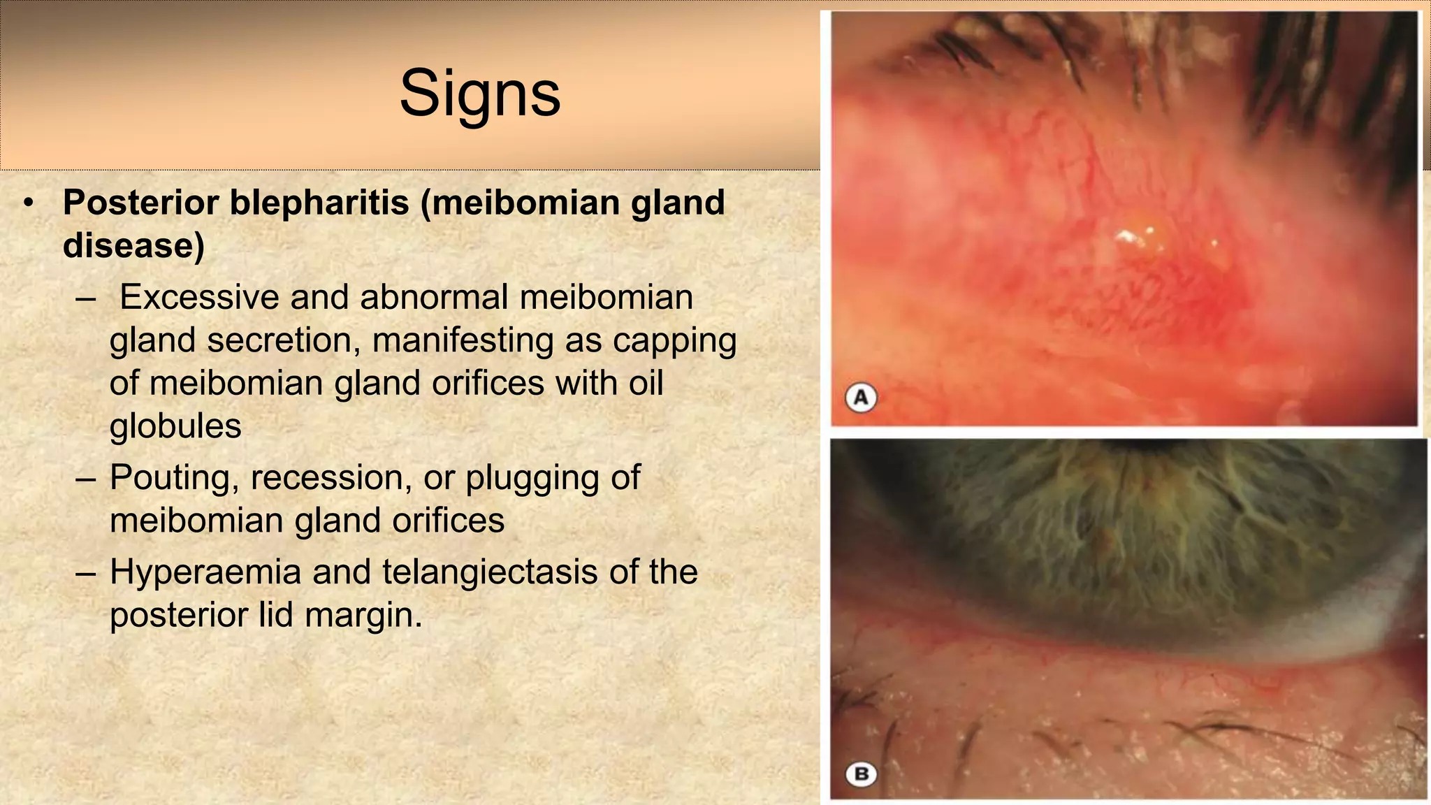 Bacterial eyelid infections and blepharitis. | PPTX
