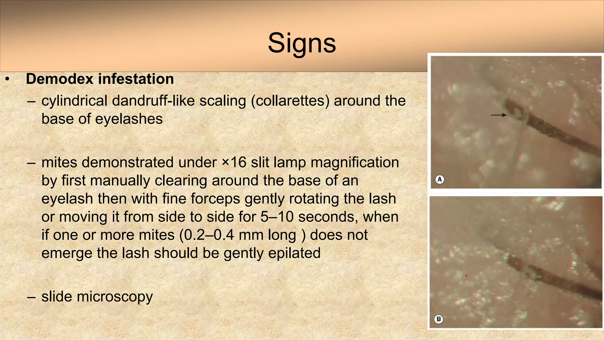 Bacterial eyelid infections and blepharitis. | PPTX
