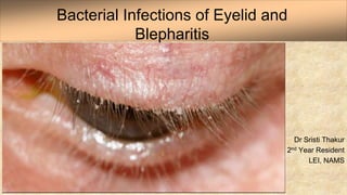 Bacterial eyelid infections and blepharitis. | PPTX
