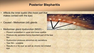Bacterial eyelid infections and blepharitis. | PPTX