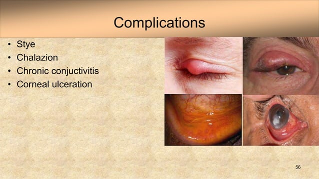 Bacterial eyelid infections and blepharitis. | PPTX