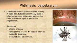 Bacterial eyelid infections and blepharitis. | PPTX