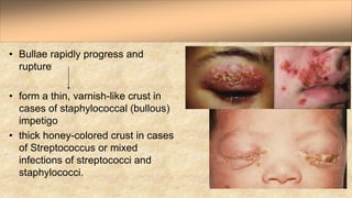 Bacterial eyelid infections and blepharitis. | PPTX
