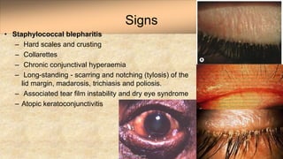 Staphylococcal Blepharitis