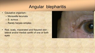 Angular Blepharoconjunctivitis