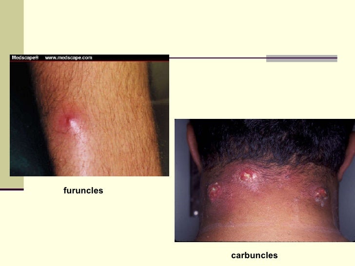 Bacterial Infection (แพทย์)