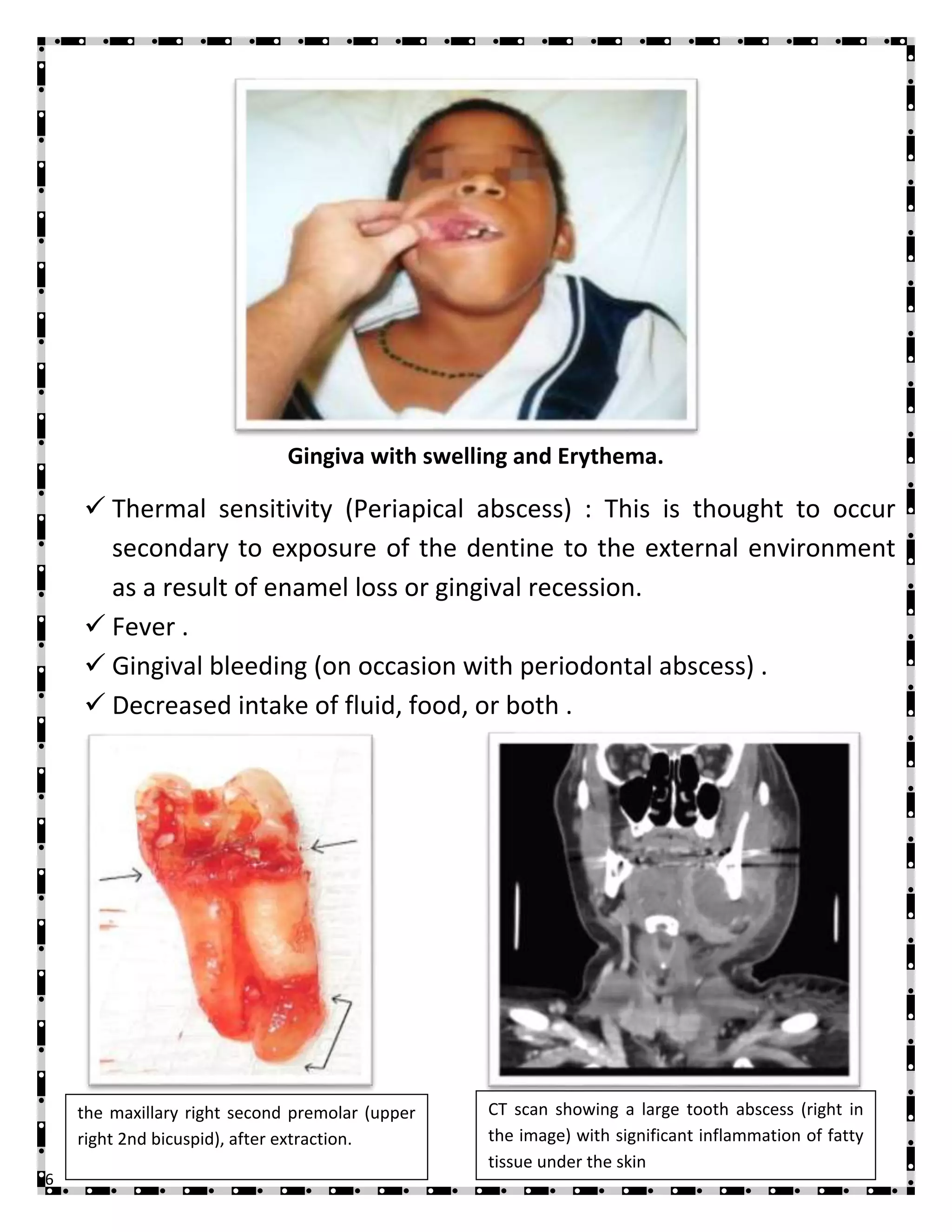 Bacterial infection affecting teeth Dental Abscess | DOCX