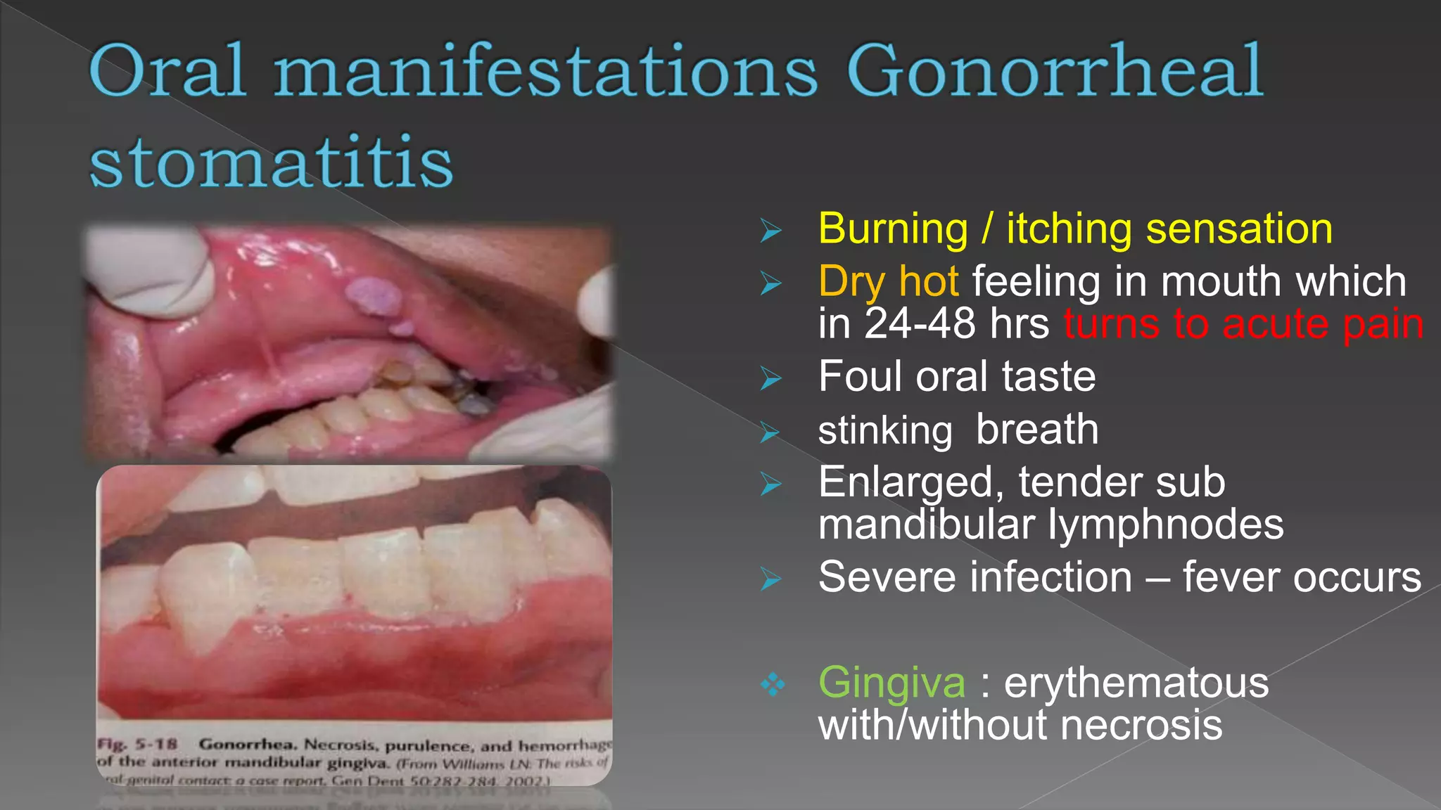 Bacterial infection of the oral cavity (khaled sadeq) | PPTX