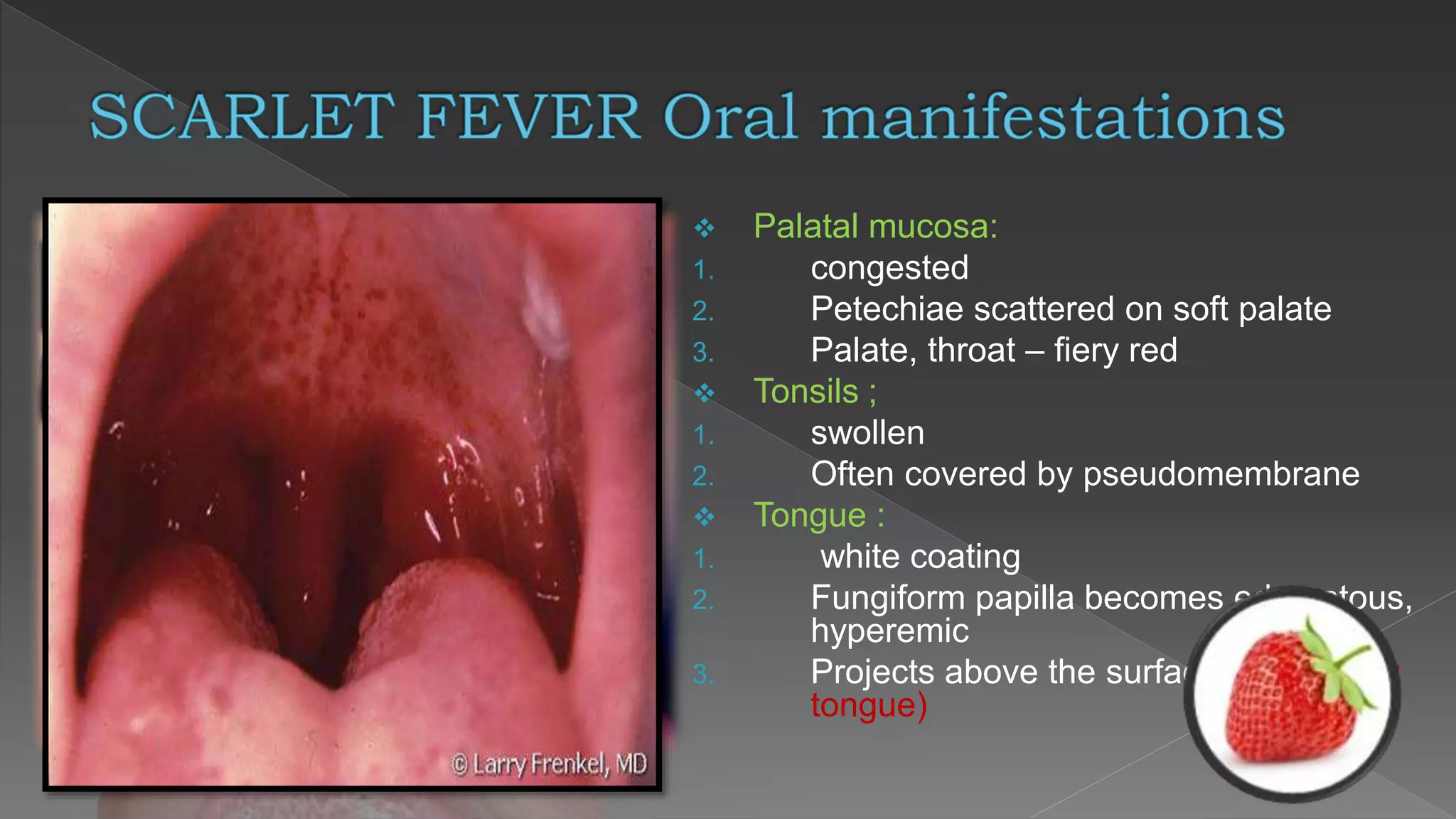 Bacterial infection of the oral cavity (khaled sadeq) | PPTX