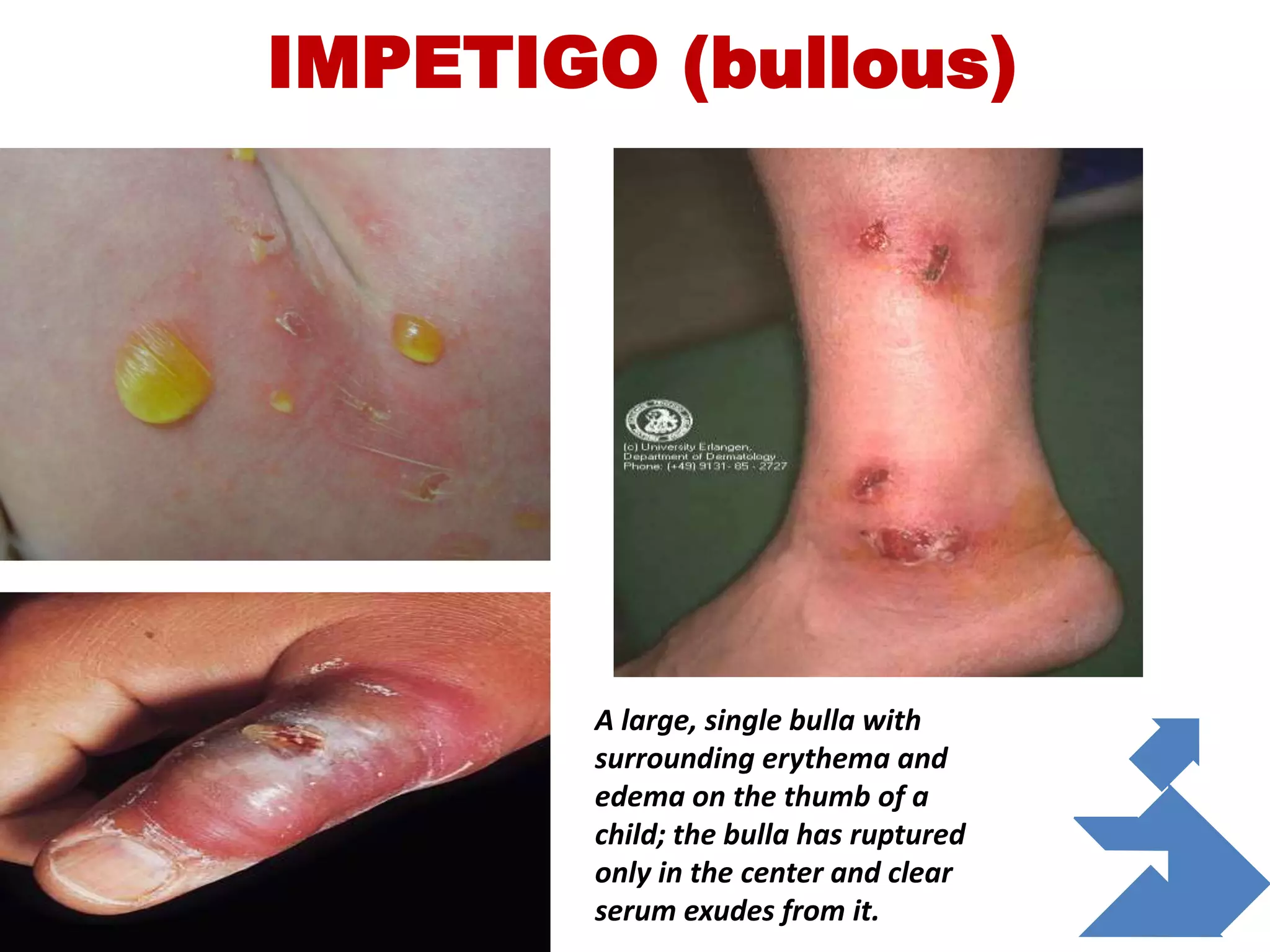 Bacterial infection of the skin | PPTX