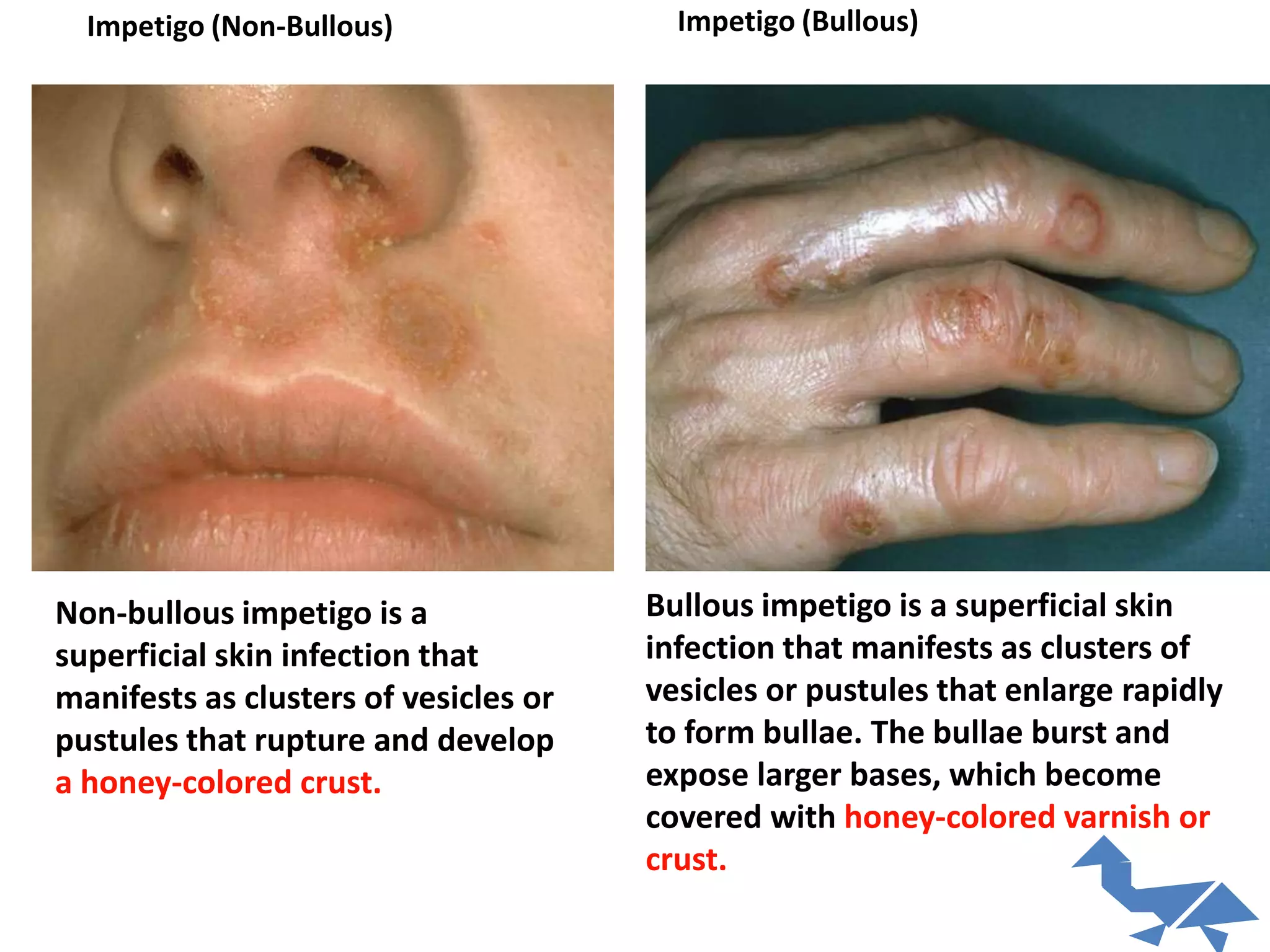 Bacterial infection of the skin | PPTX