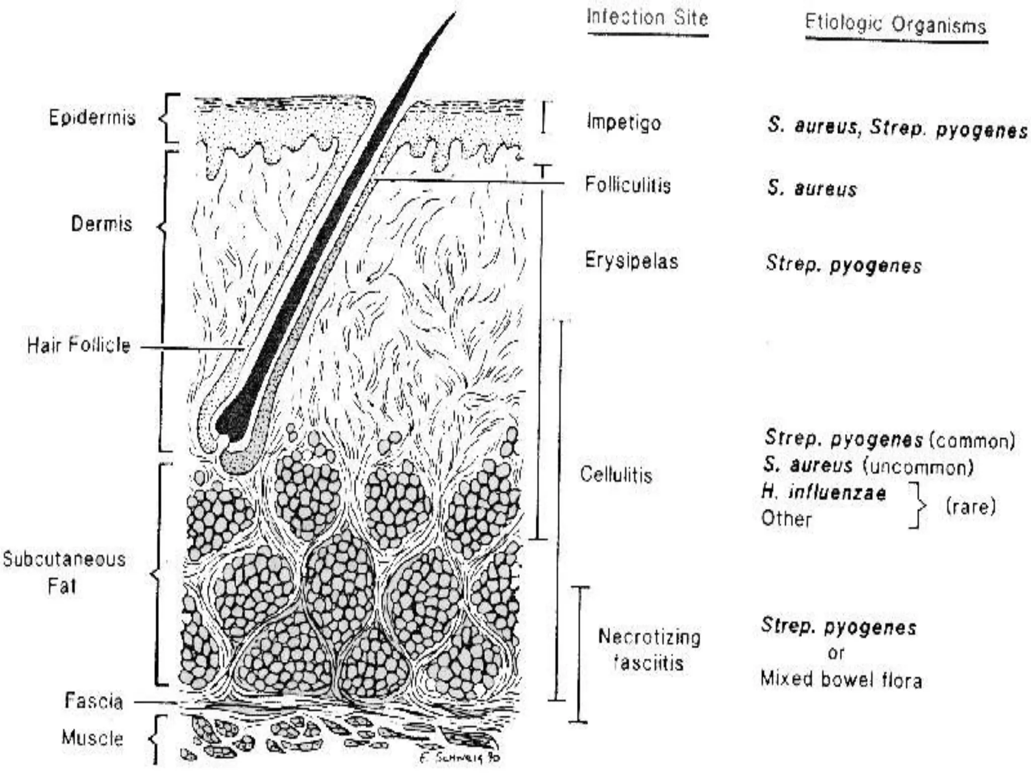 Bacterial infection of the skin | PPTX