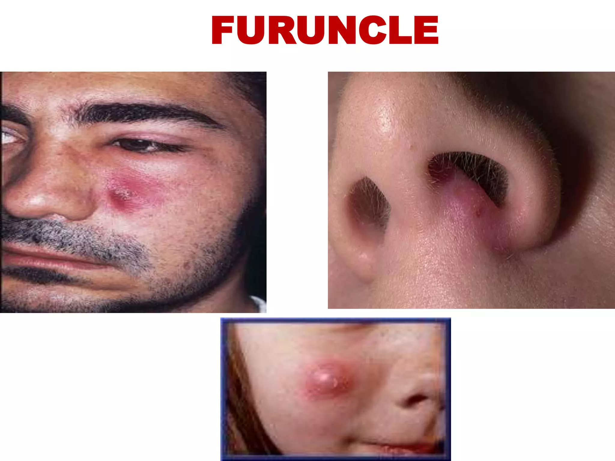 Bacterial infection of the skin | PPTX