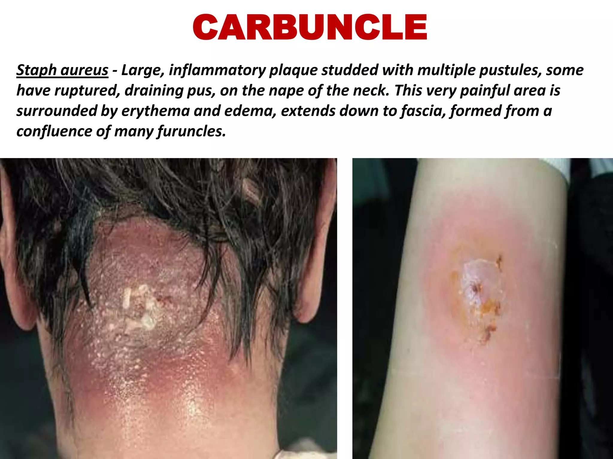 Bacterial infection of the skin | PPTX