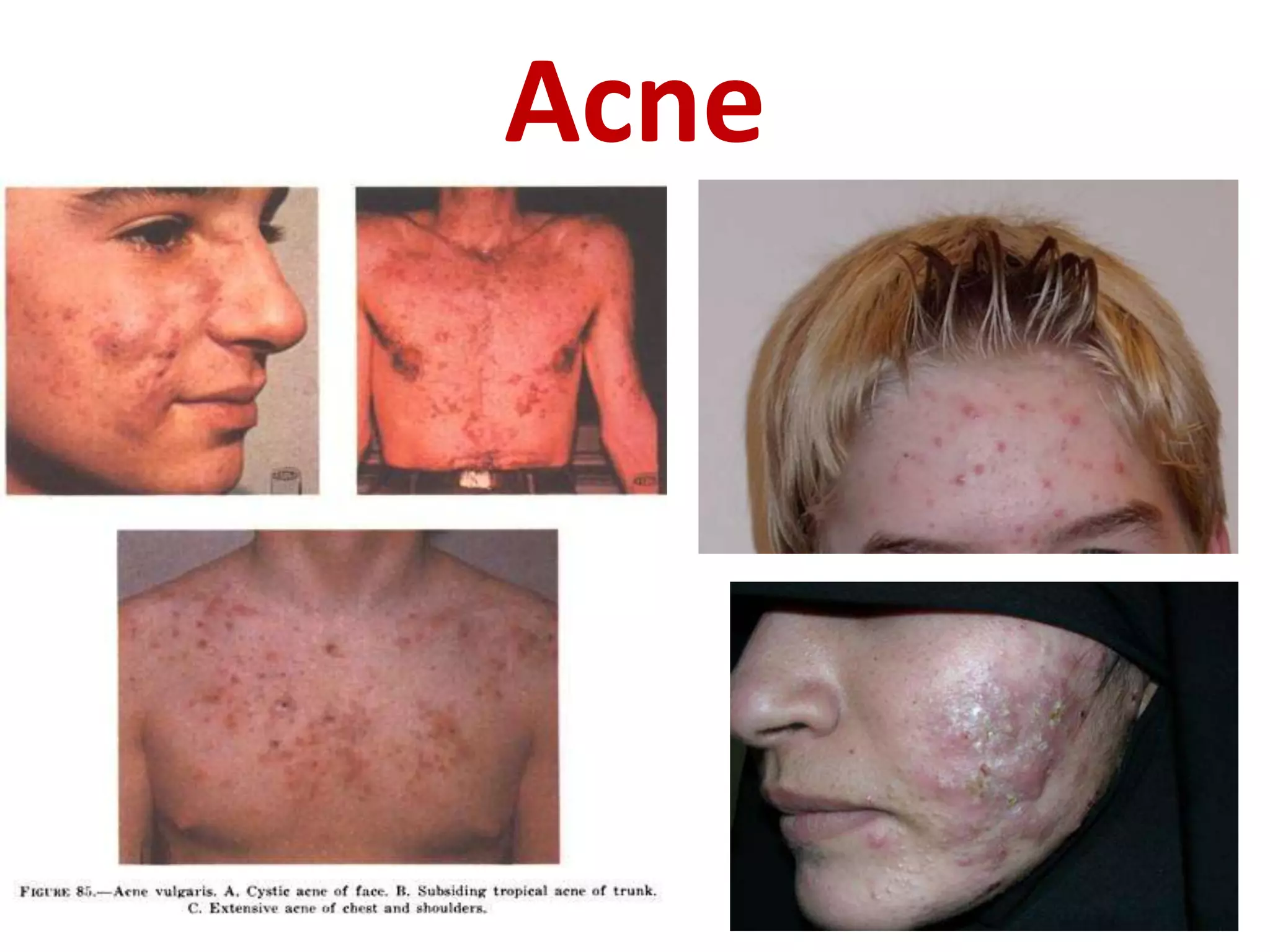 Bacterial infection of the skin | PPTX