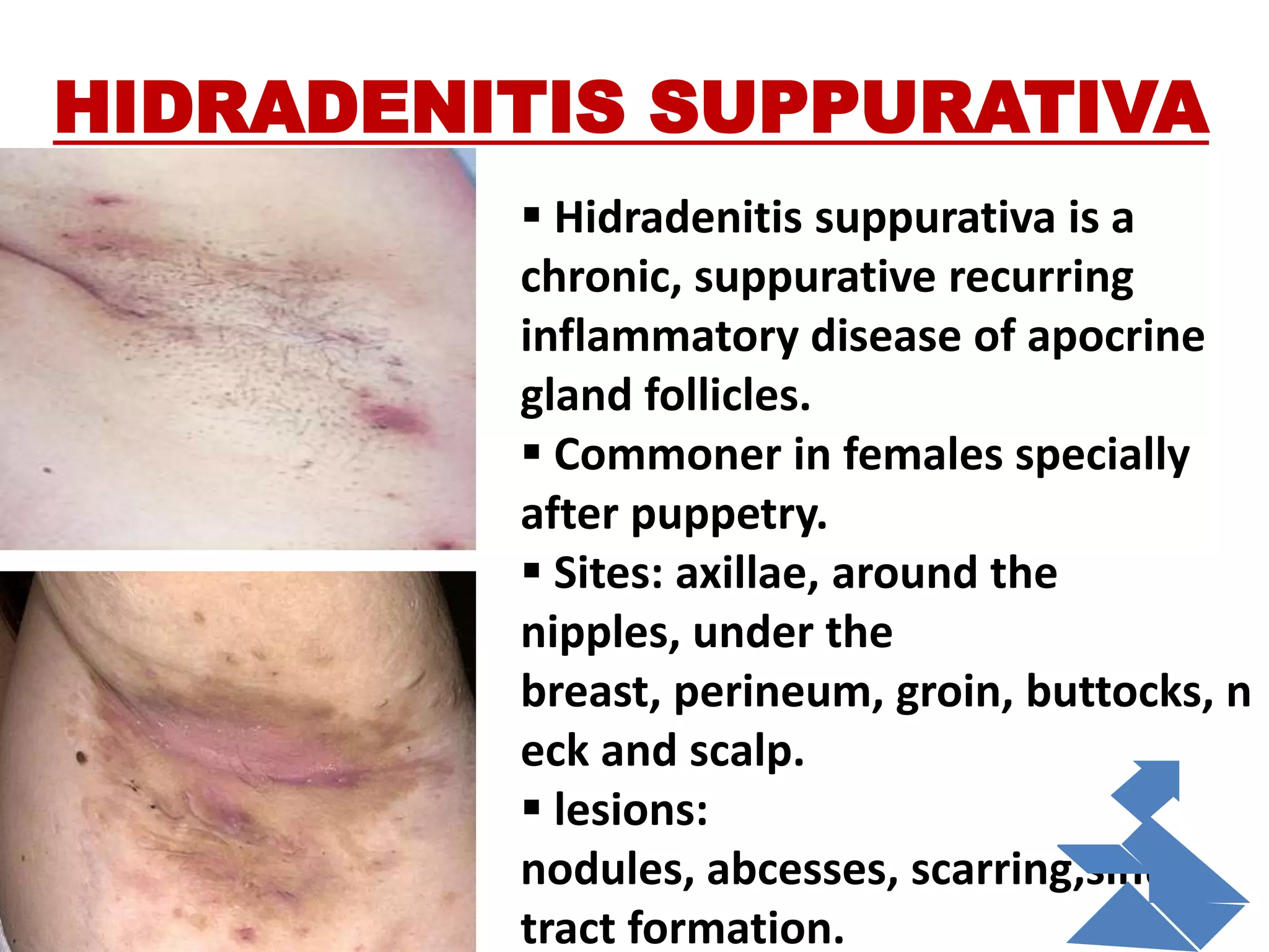 Bacterial infection of the skin | PPTX