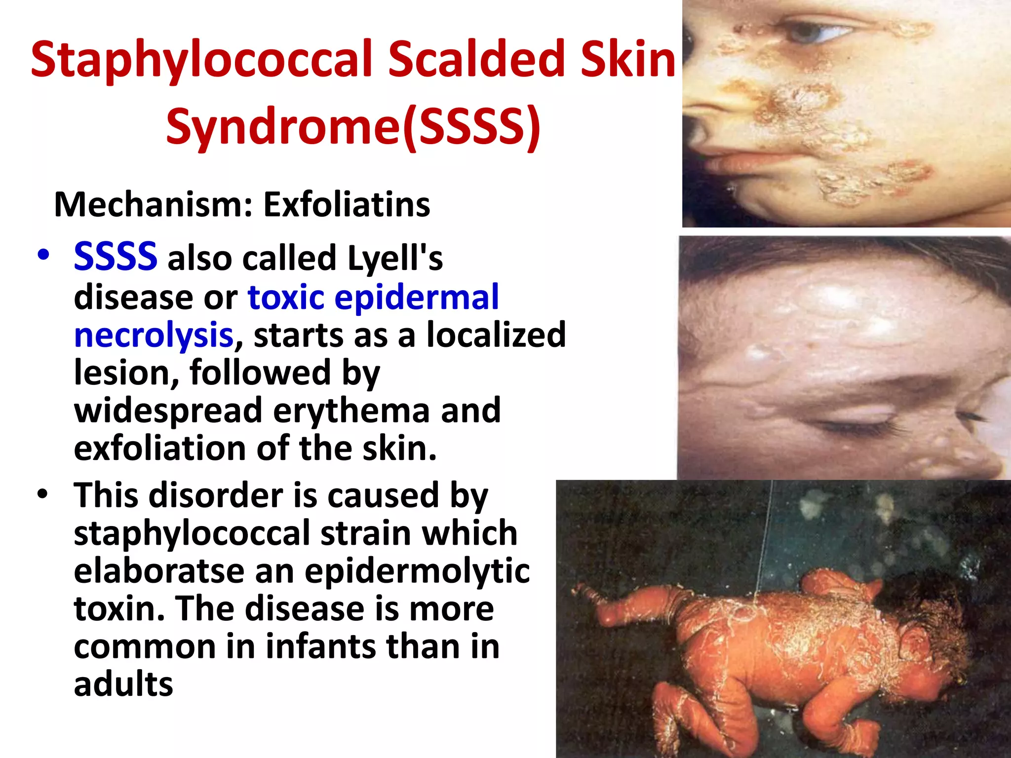 Bacterial infection of the skin | PPTX