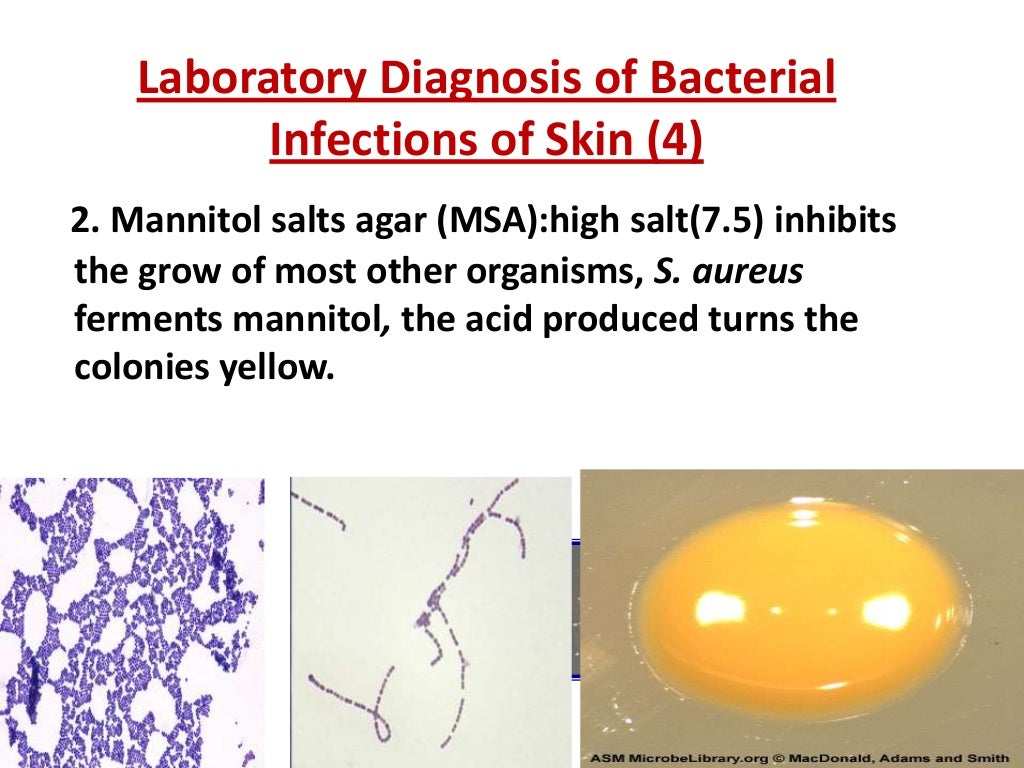 Bacterial infection of the skin