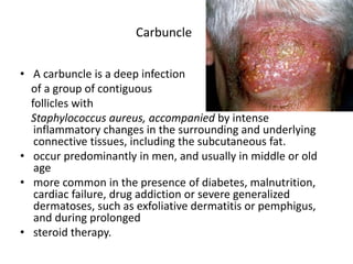 Bacterial infections | PPT
