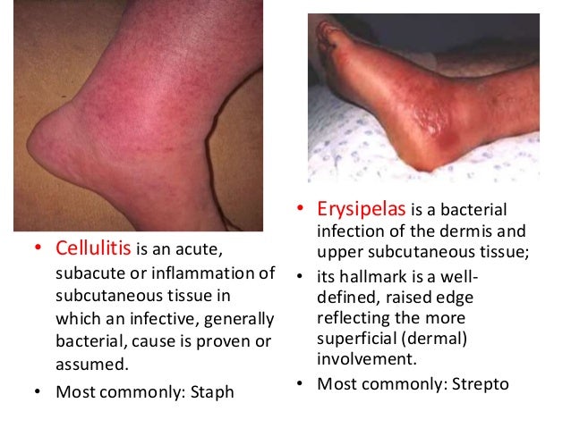 Bacterial infections