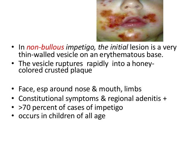 Bacterial infections