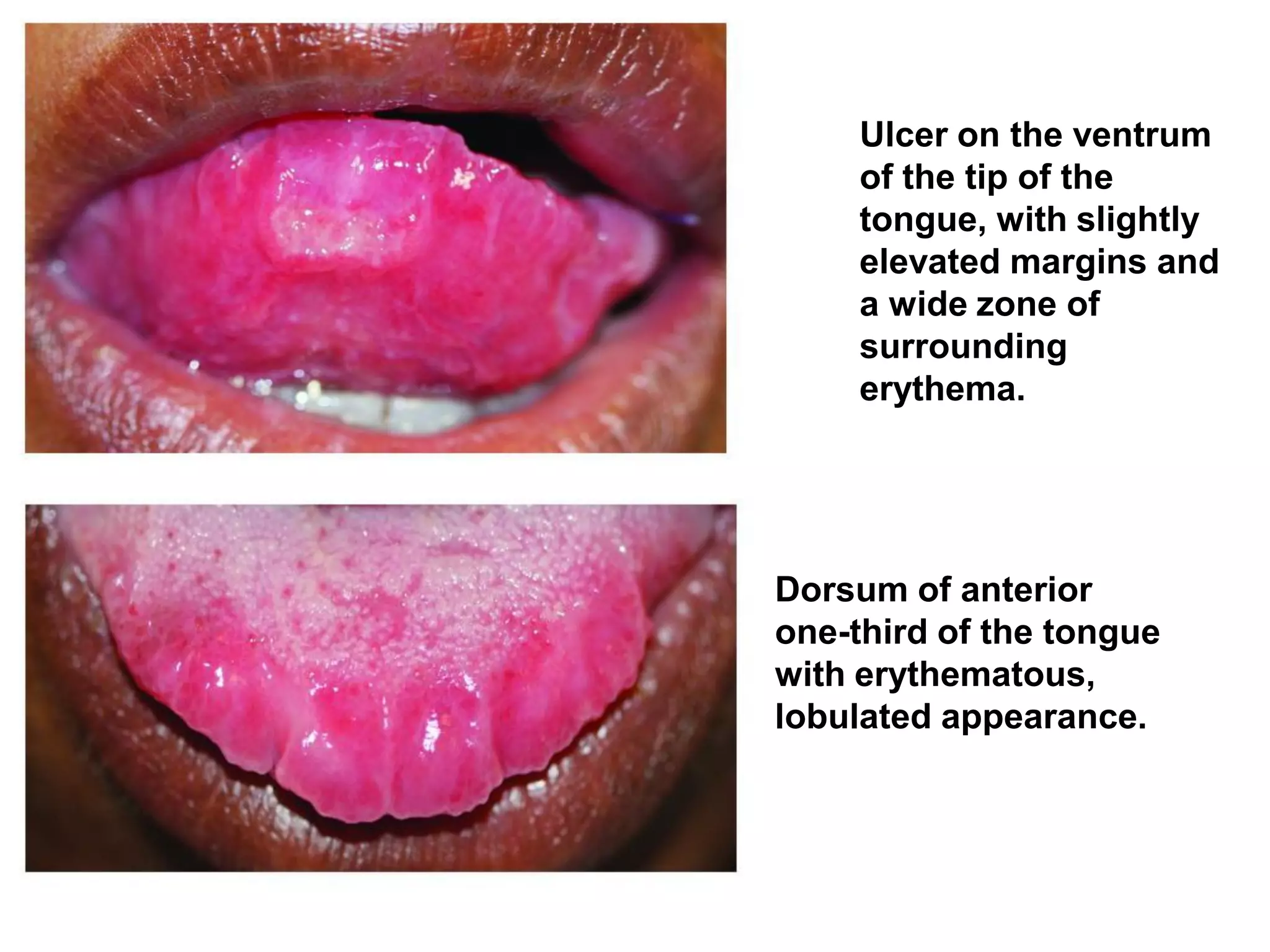 Bacterial infections of mouth | PDF