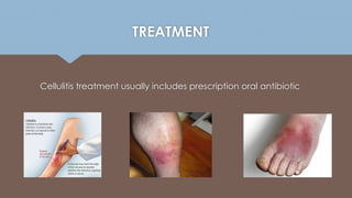 Bacterial Infections of skin-1.pptx...... | PPTX