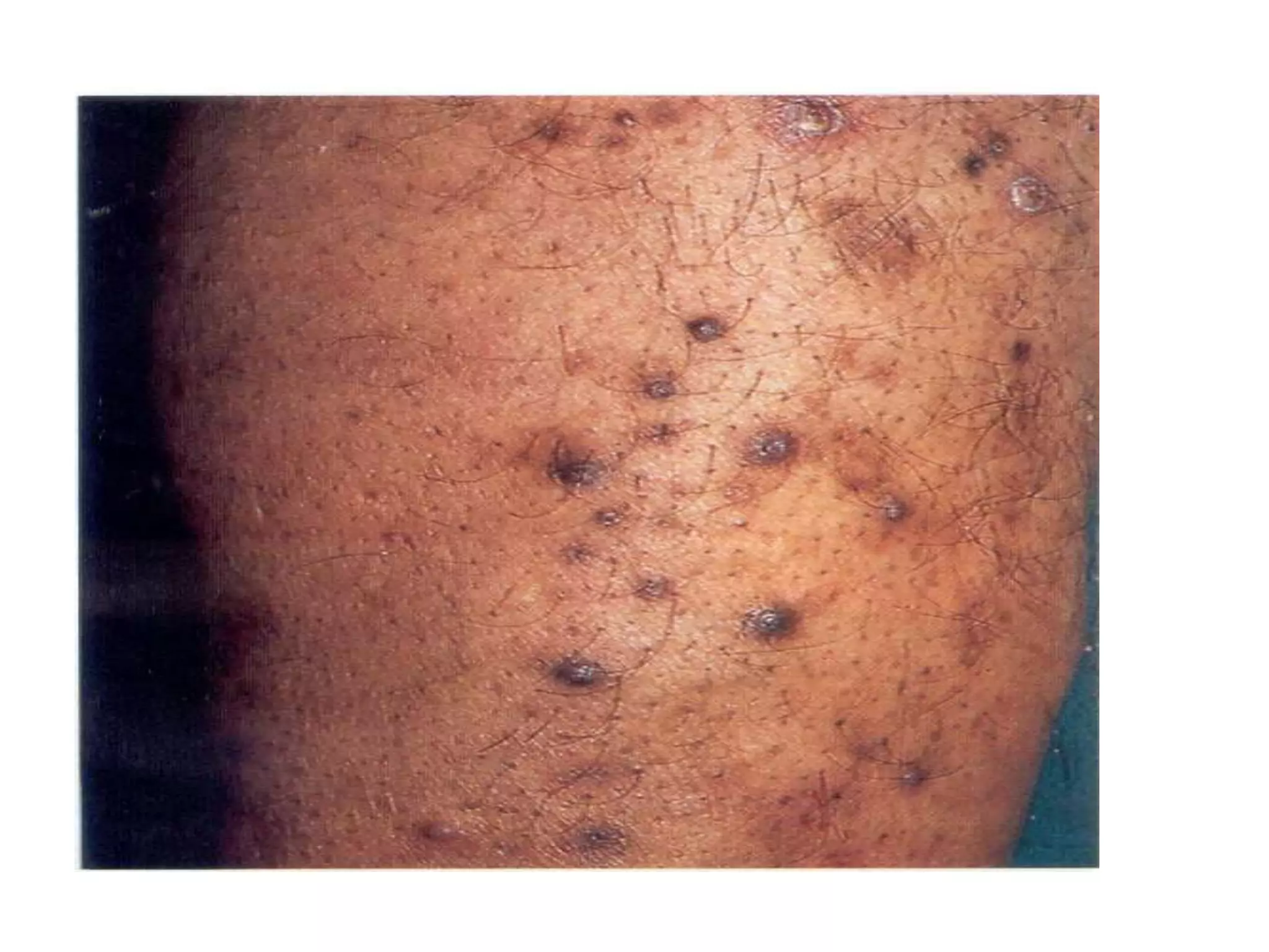 Bacterial infections of the skin | PPT