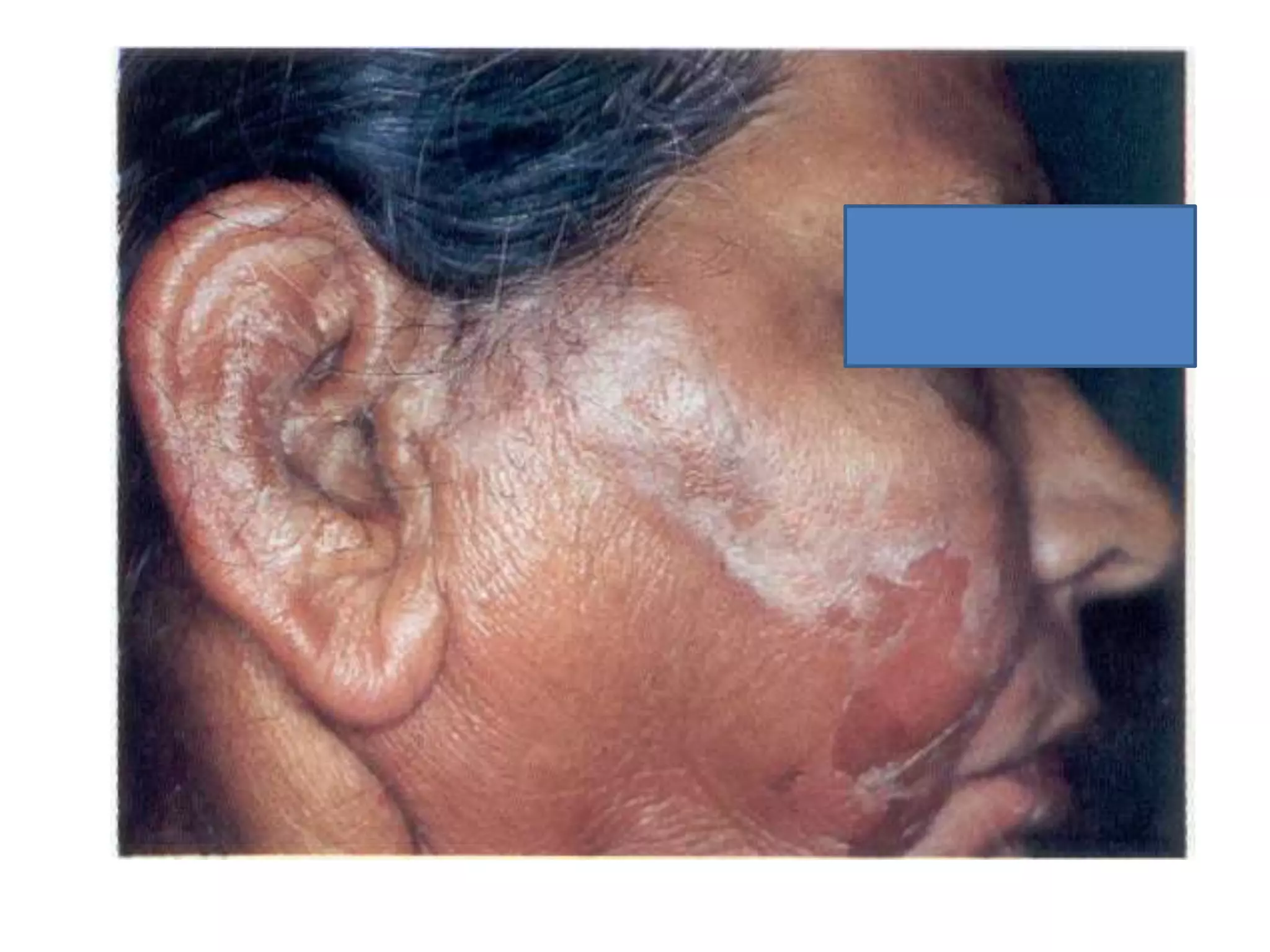 Bacterial infections of the skin | PPT