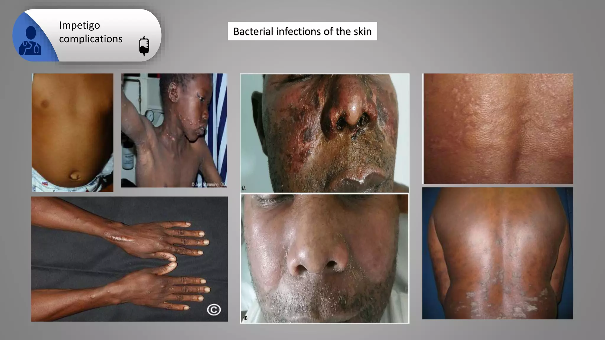 Bacterial infections of the skin.pptx