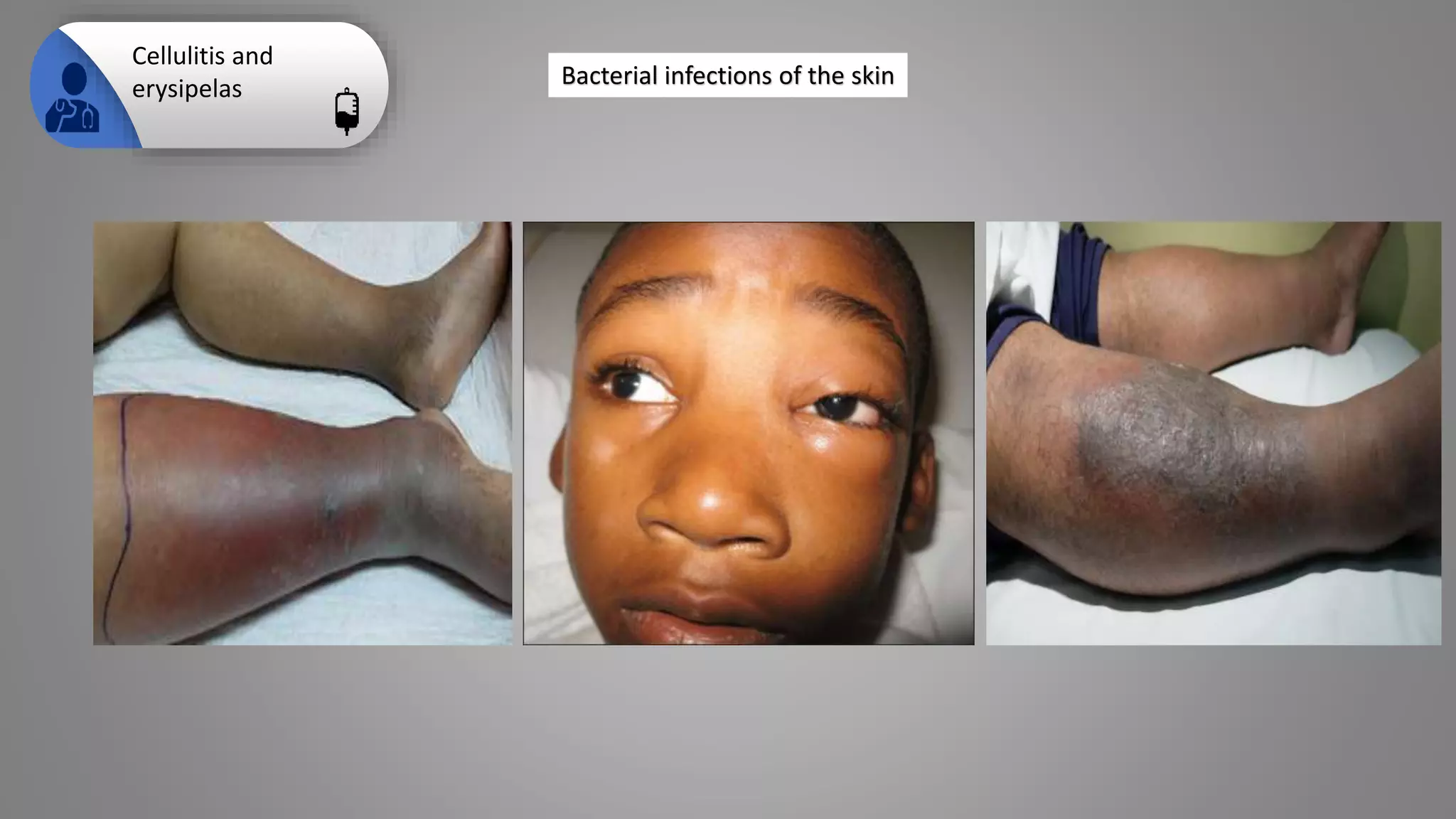 Bacterial infections of the skin.pptx