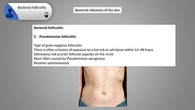 Bacterial infections of the skin.pptx