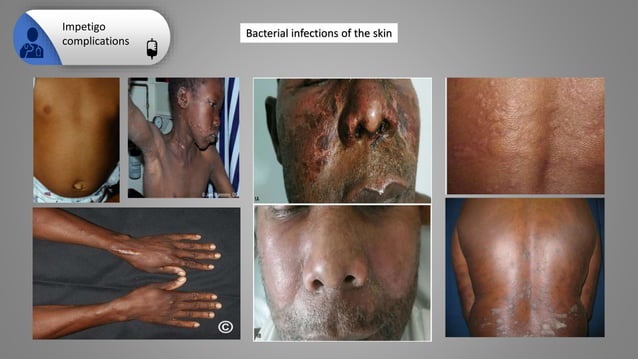Bacterial infections of the skin.pptx