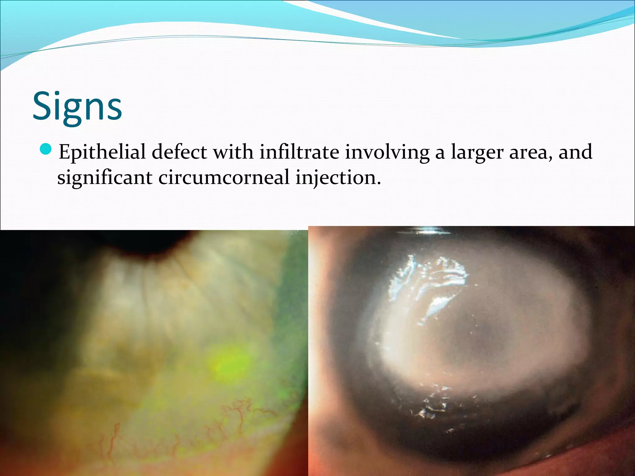 Bacterial keratitis | PPT