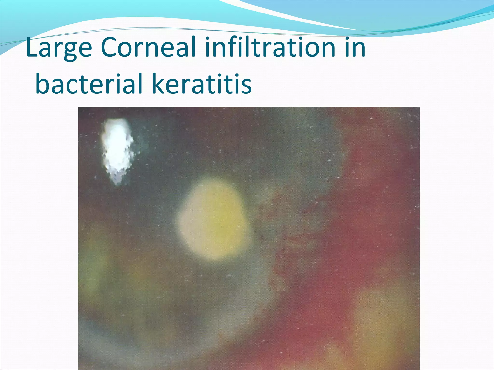 Bacterial keratitis | PPT