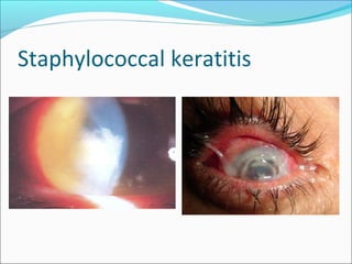 Bacterial keratitis | PPT