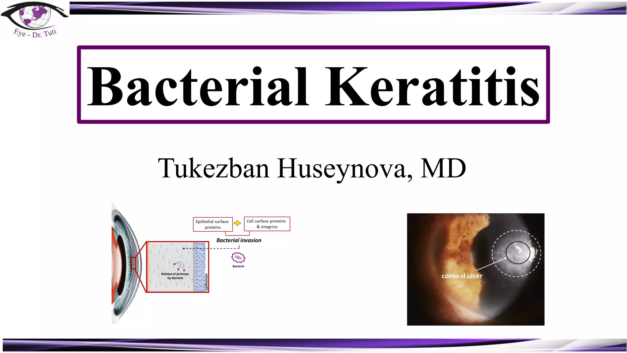 Bacterial keratitis | PDF