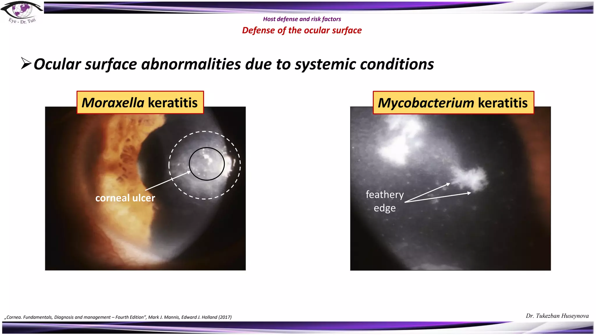 Bacterial keratitis | PDF