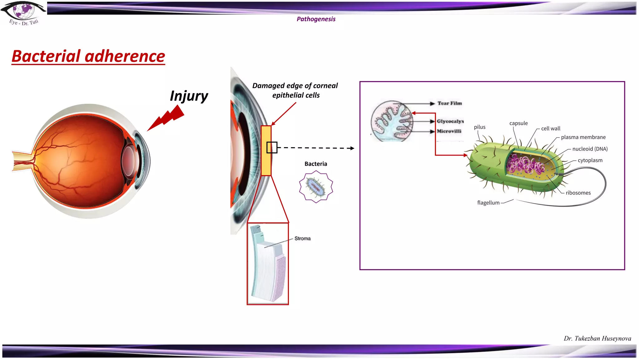 Bacterial keratitis | PDF