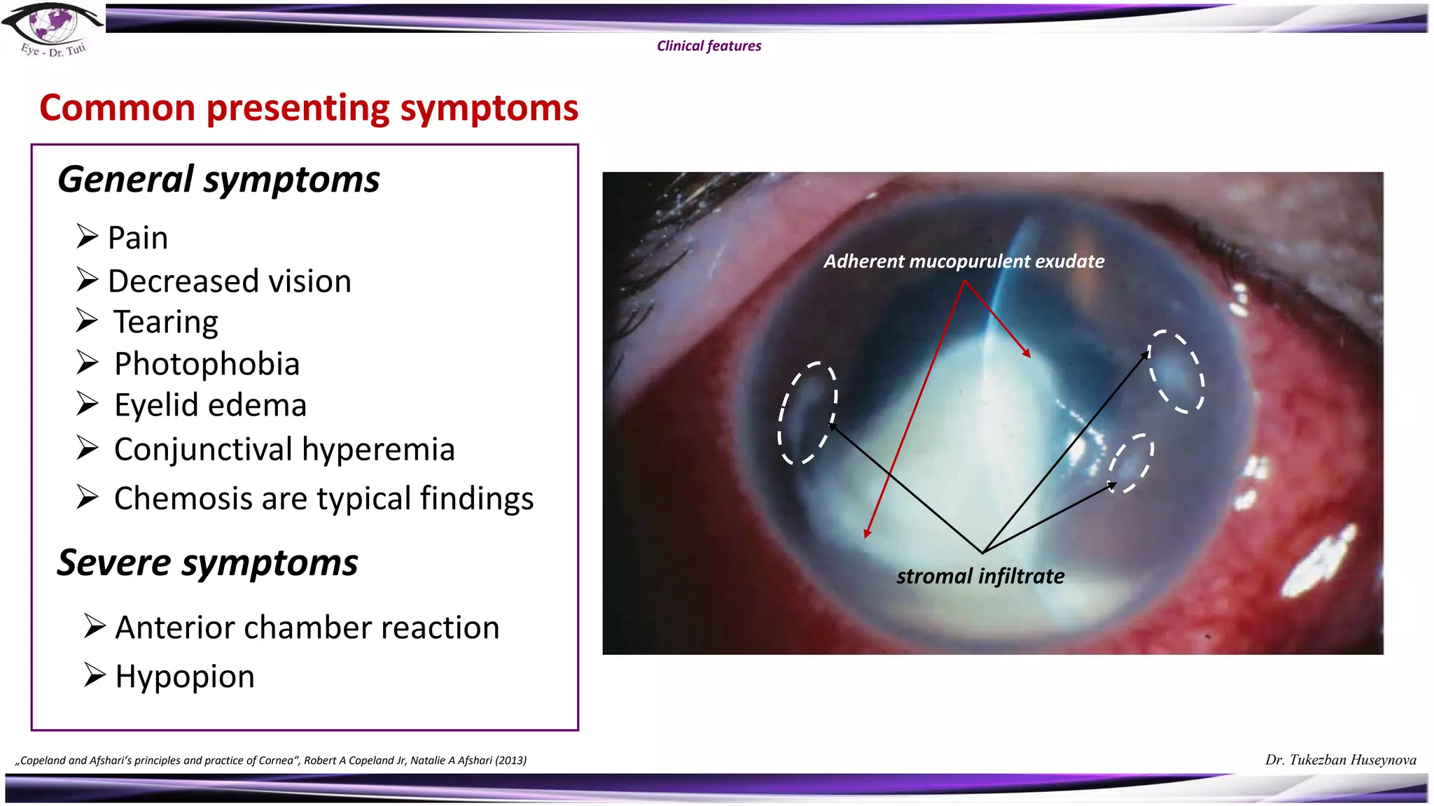 Bacterial keratitis | PDF