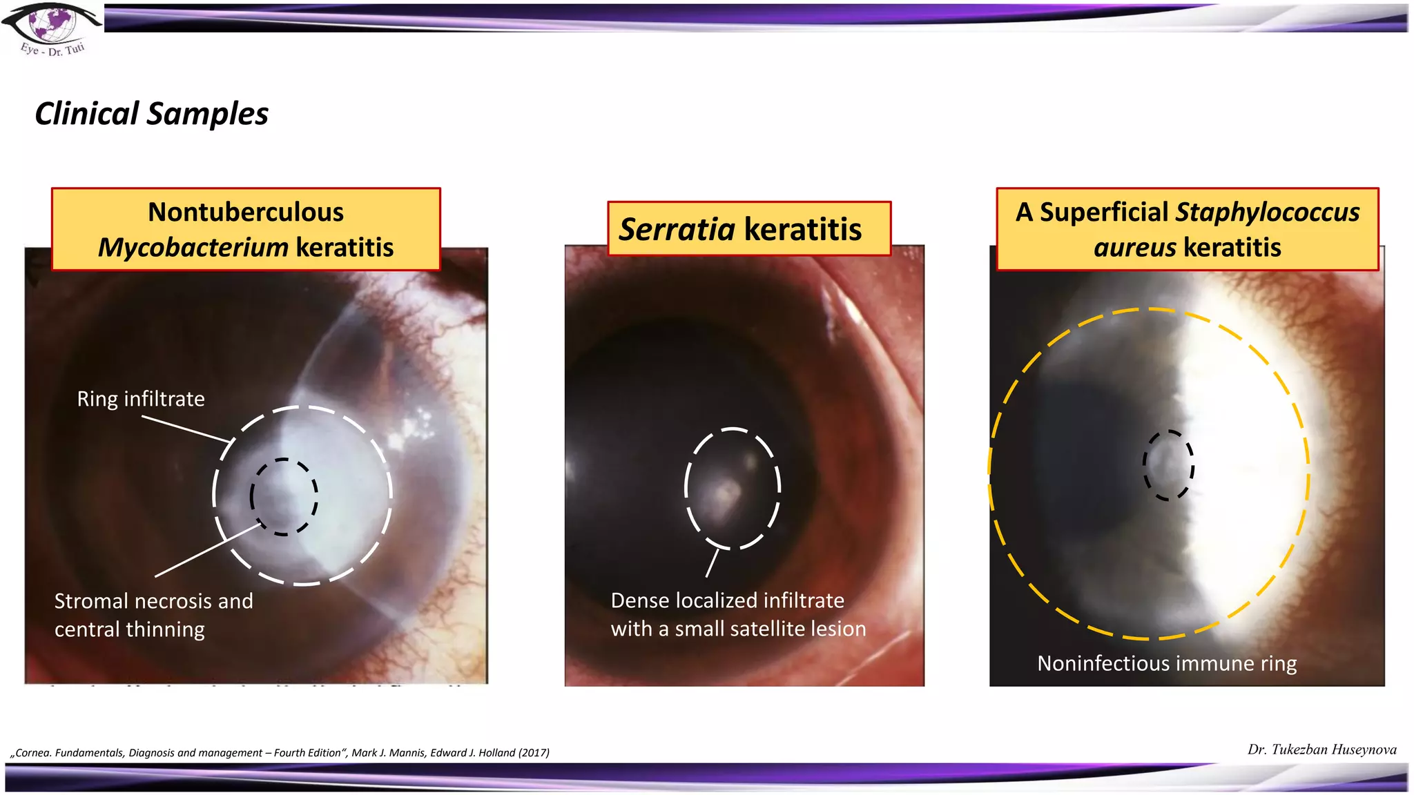 Bacterial keratitis | PDF