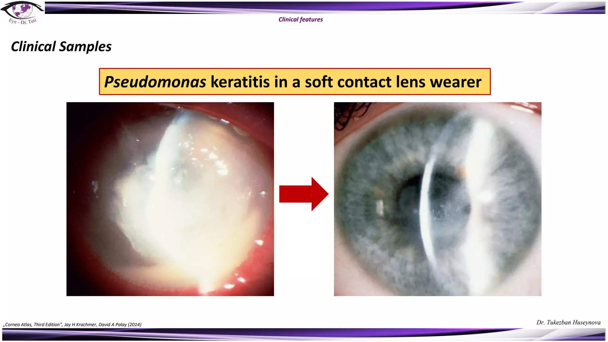 Bacterial keratitis | PDF