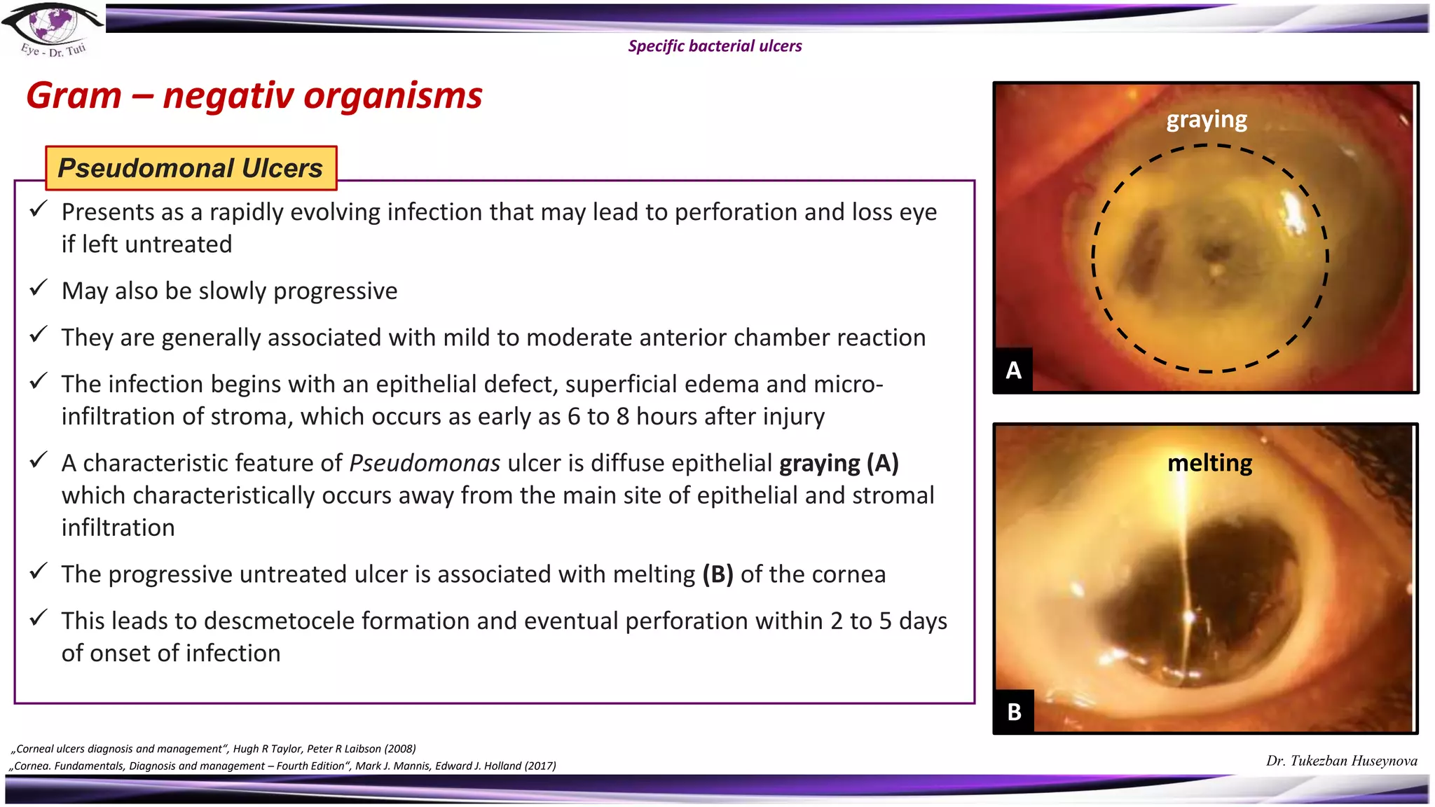 Bacterial keratitis | PDF