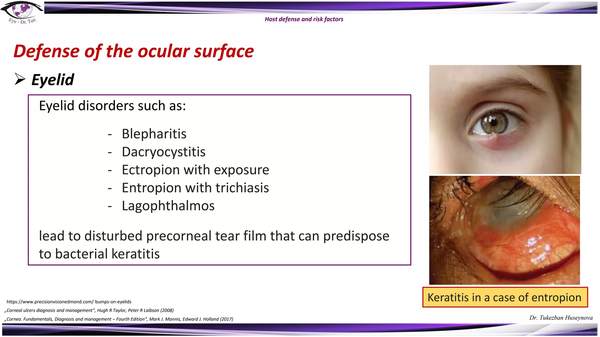 Bacterial keratitis | PDF