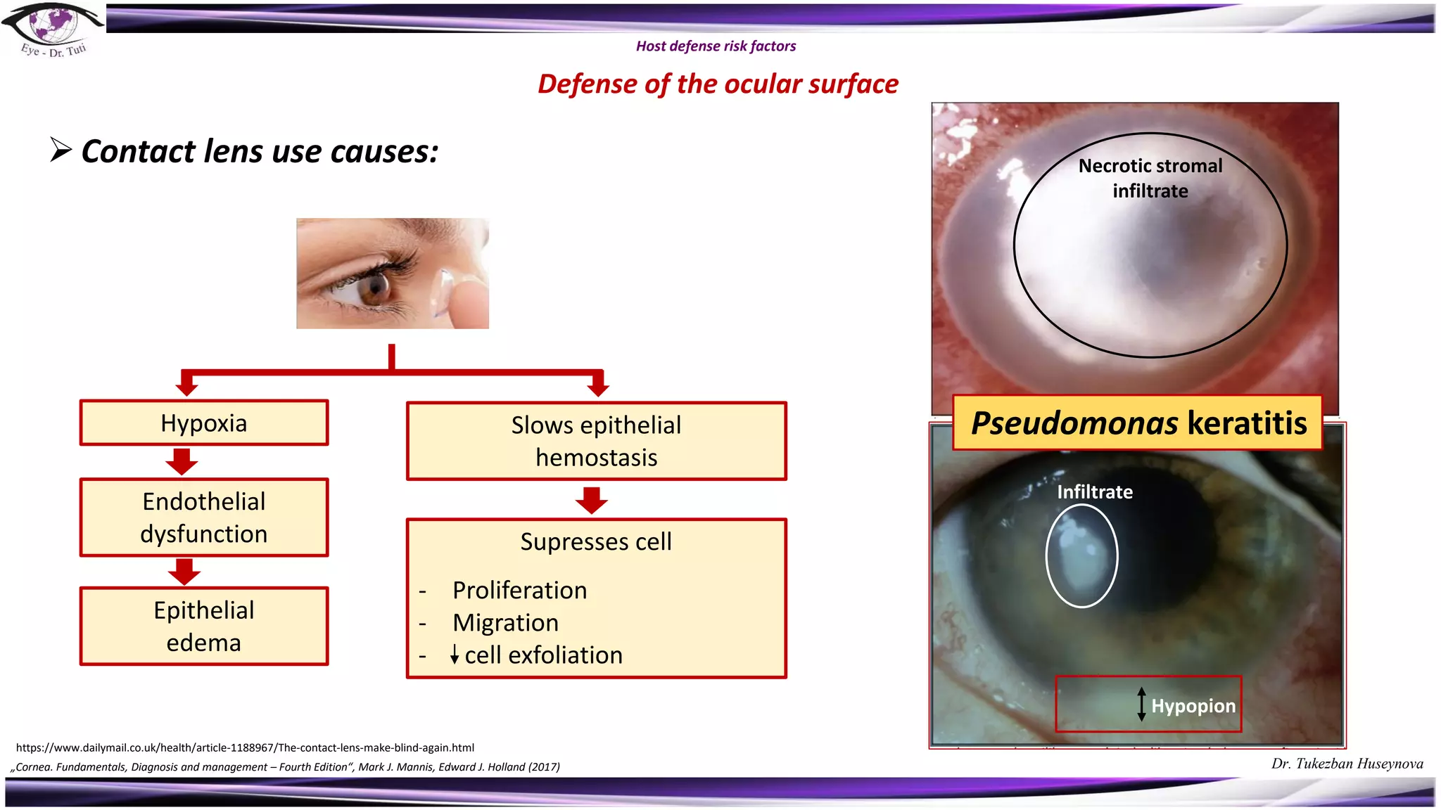 Bacterial keratitis | PDF
