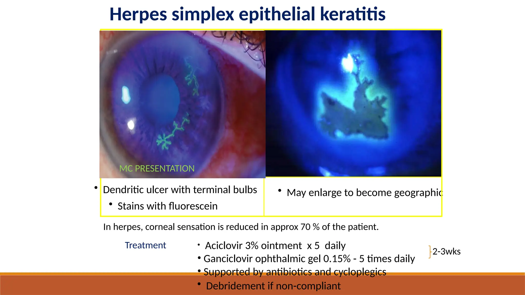 a presentation on infective bacterial keratitis.pptx