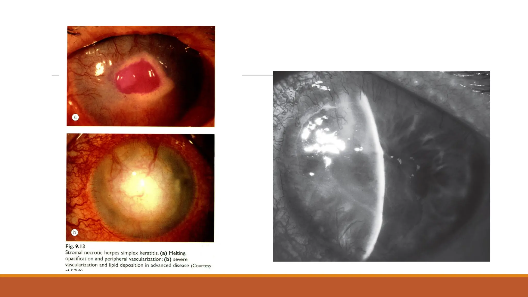 a presentation on infective bacterial keratitis.pptx | Eye and Vision Conditions | Diseases and ...