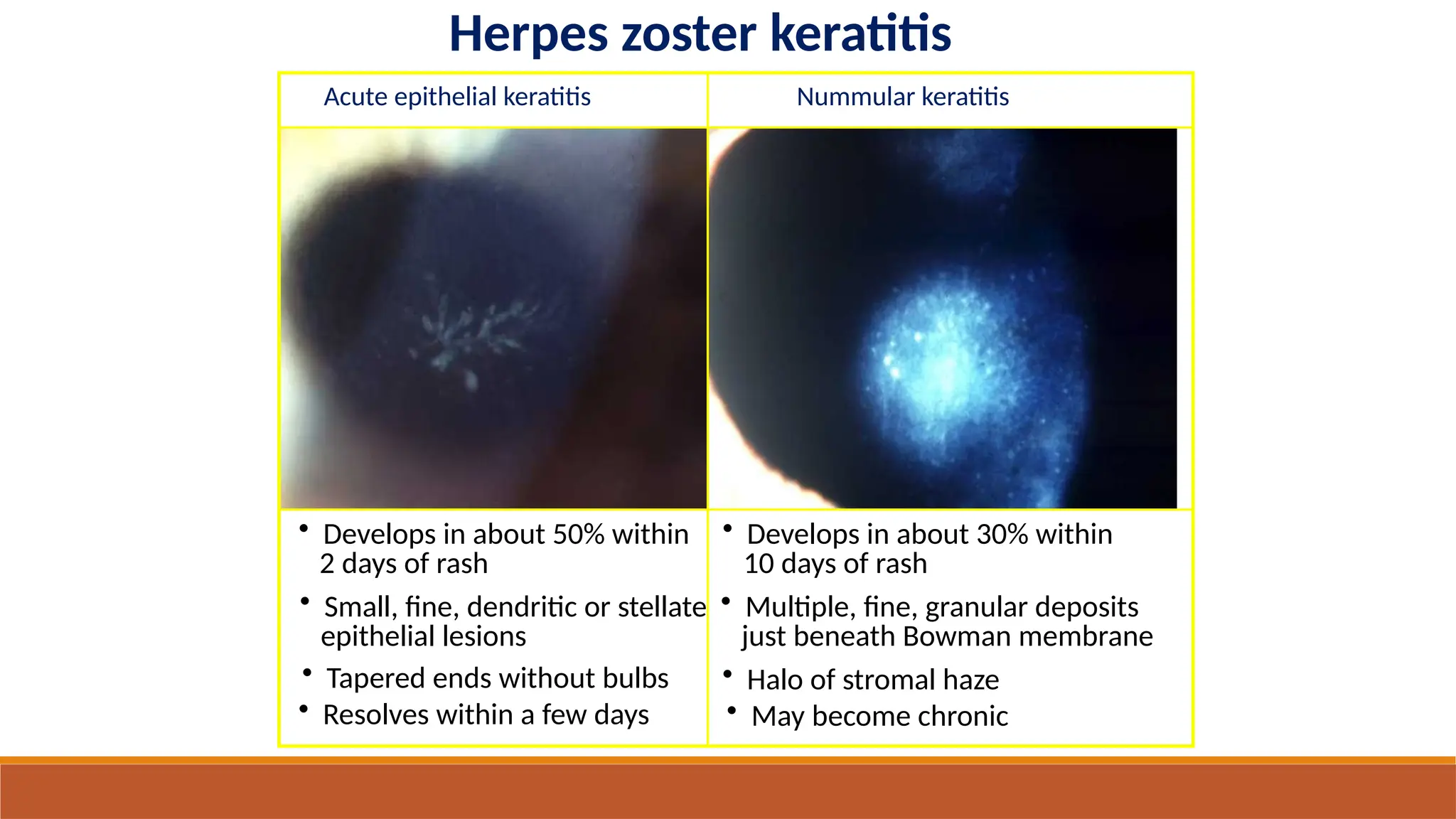 a presentation on infective bacterial keratitis.pptx | Eye and Vision Conditions | Diseases and ...