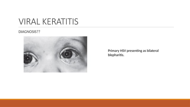 a presentation on infective bacterial keratitis.pptx | Eye and Vision Conditions | Diseases and ...
